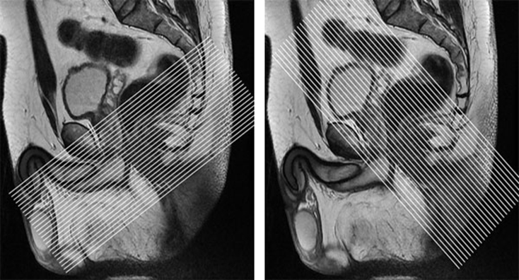 MR Perianal Fistula W/WO Protocol | OHSU